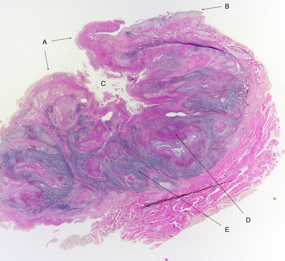 Histologie: Die Diphtherie der Gaumenmandel, Teil 2