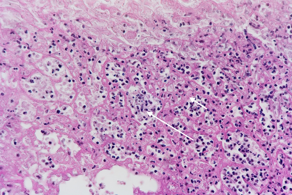 Histologie: Die Diphtherie der Gaumenmandel, Teil 2