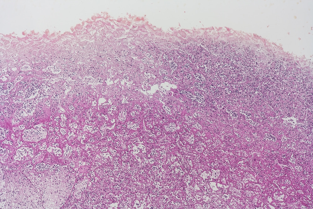 Histologie: Die Diphtherie der Gaumenmandel, Teil 2